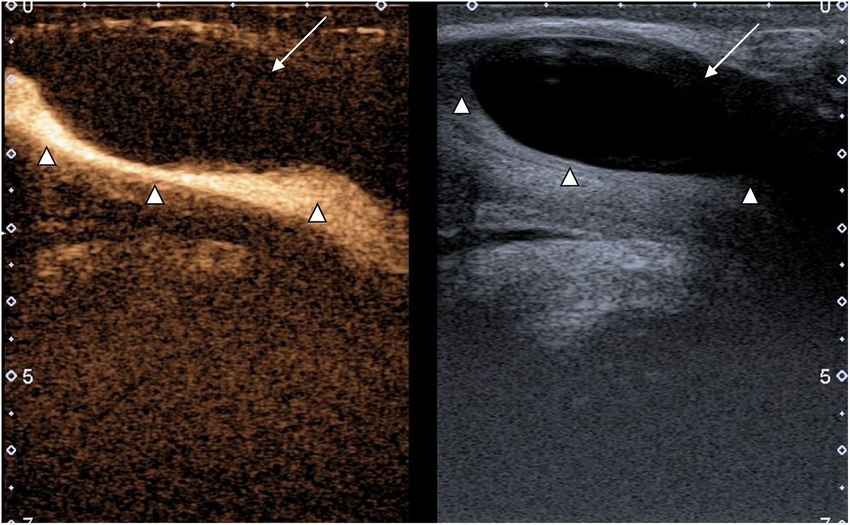 Siringocele imperforado de la glándula de Cowper. Diagnóstico por ...