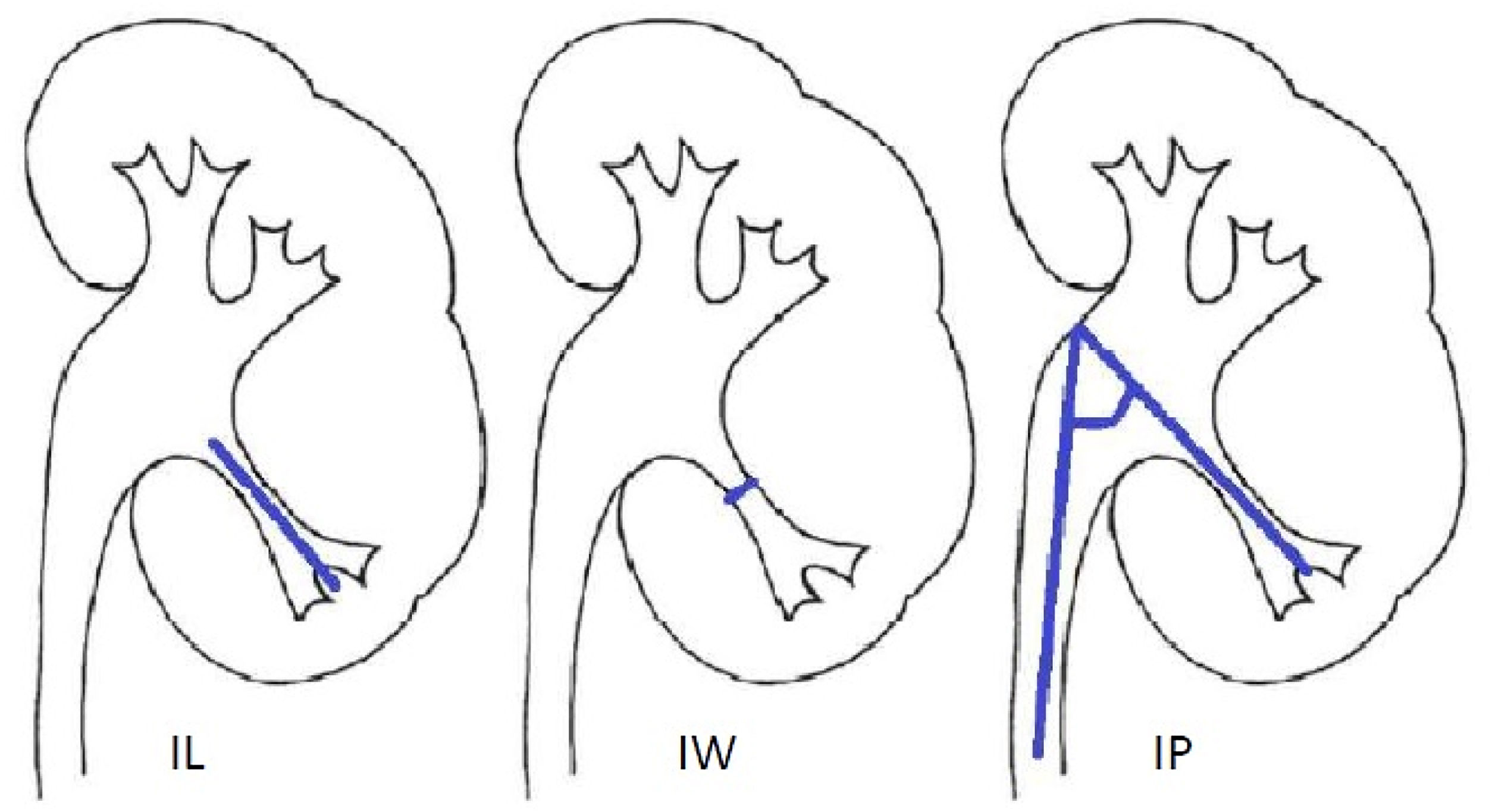Litotricia extracorpórea por ondas de choque (LEOCh) Para litiasis de ...