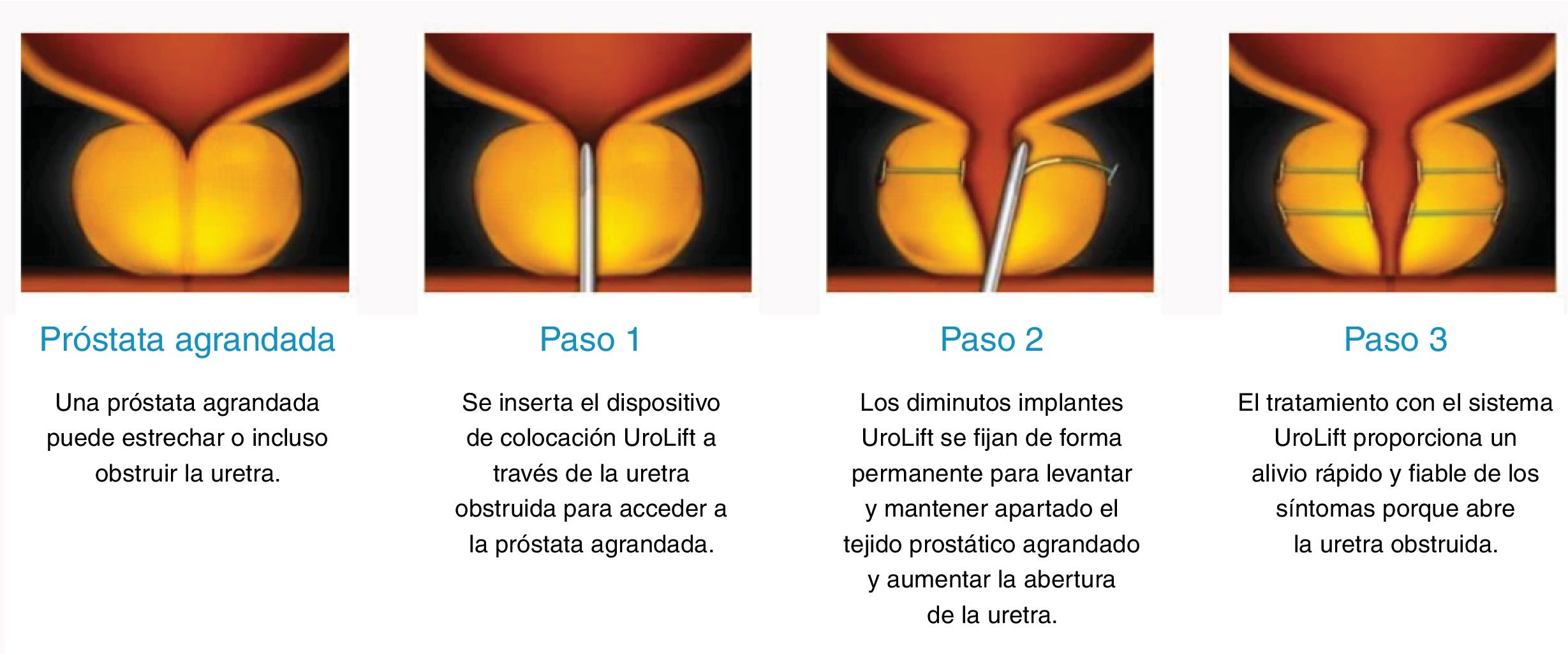 Aplicación clínica del sistema de liberación uretral UroLift® en España ...