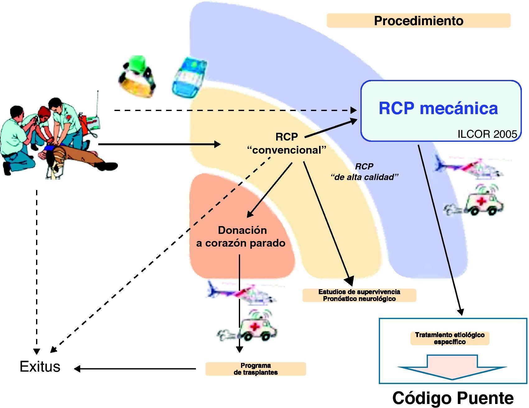 Revascularización coronaria durante la resucitación cardiopulmonar ...