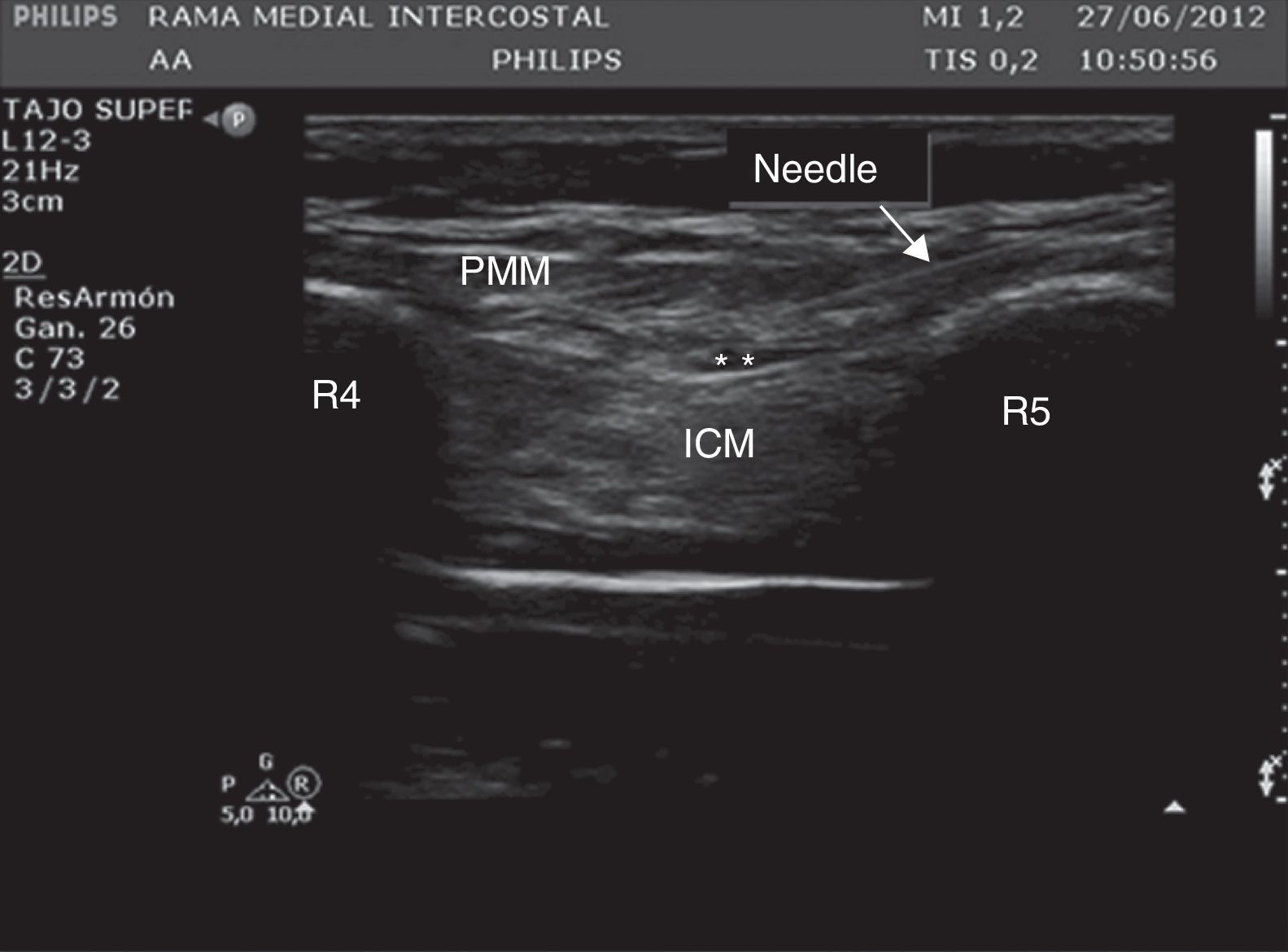 A new thoracic interfascial plane block as anesthesia for difficult ...