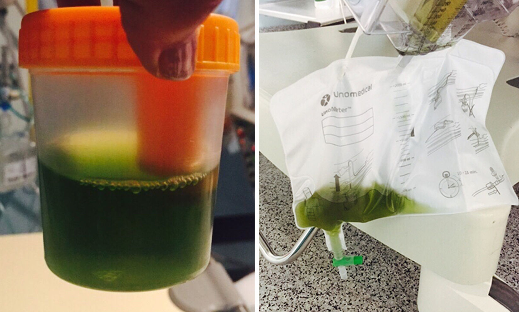 Orina verde asociada a infusión de propofol | Medicina Intensiva