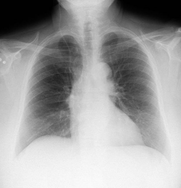real tracheal deviation