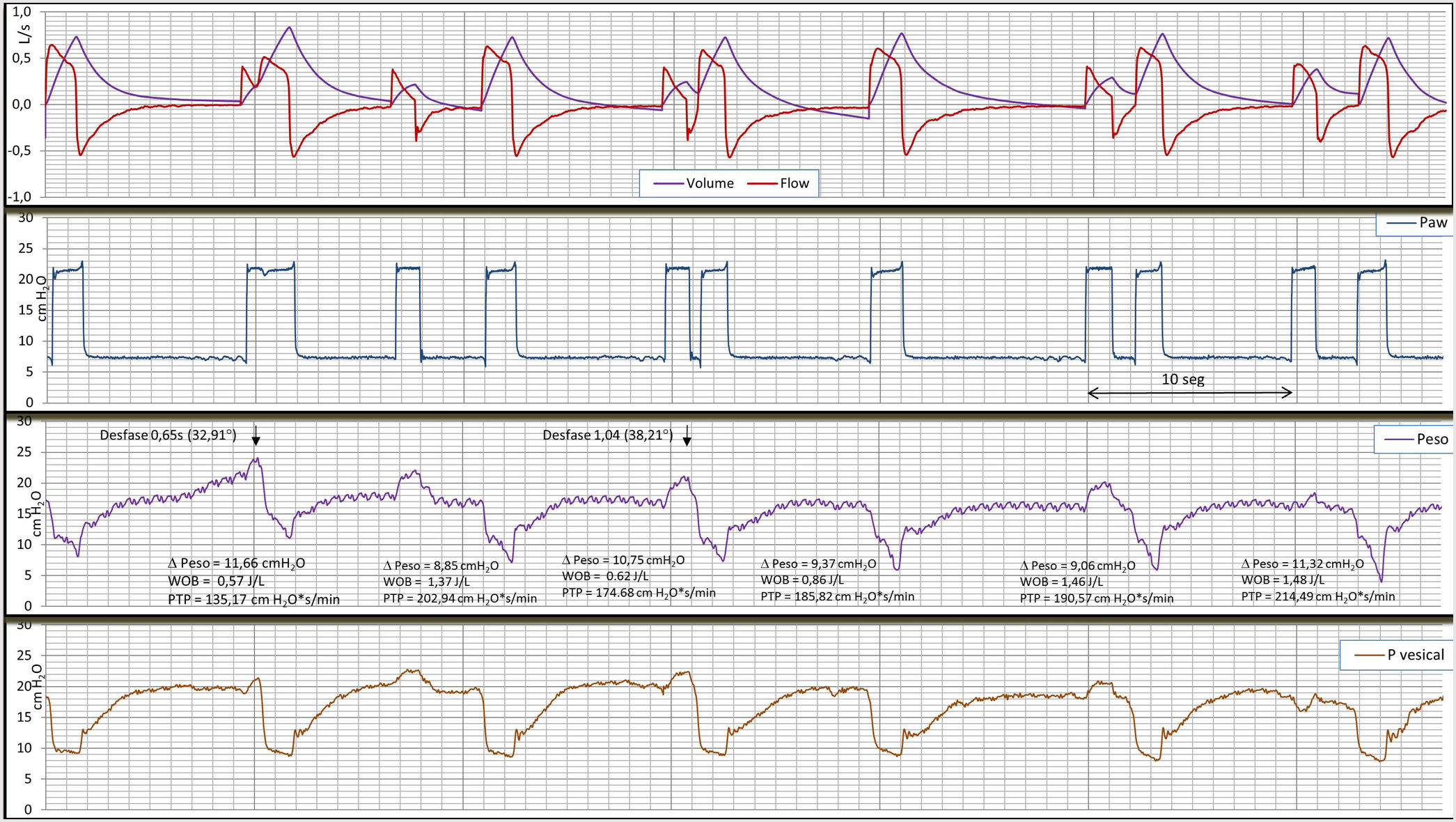 Doble trigger y ¿falso? reverse trigger | Medicina Intensiva