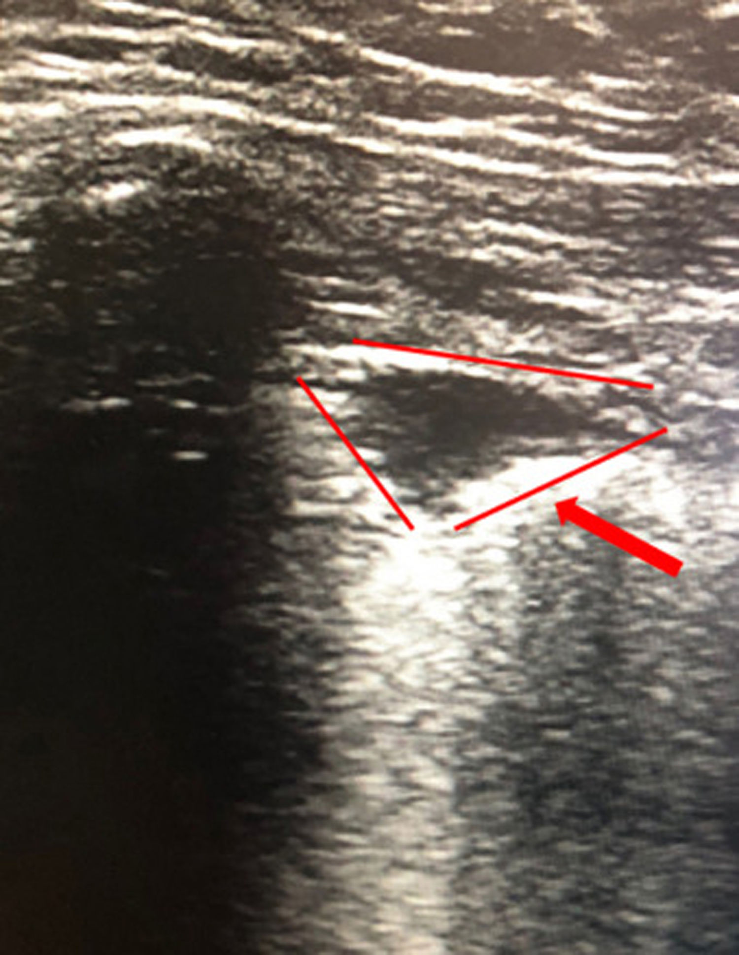 Diagnóstico de infarto pulmonar por ecografía torácica en paciente con ...