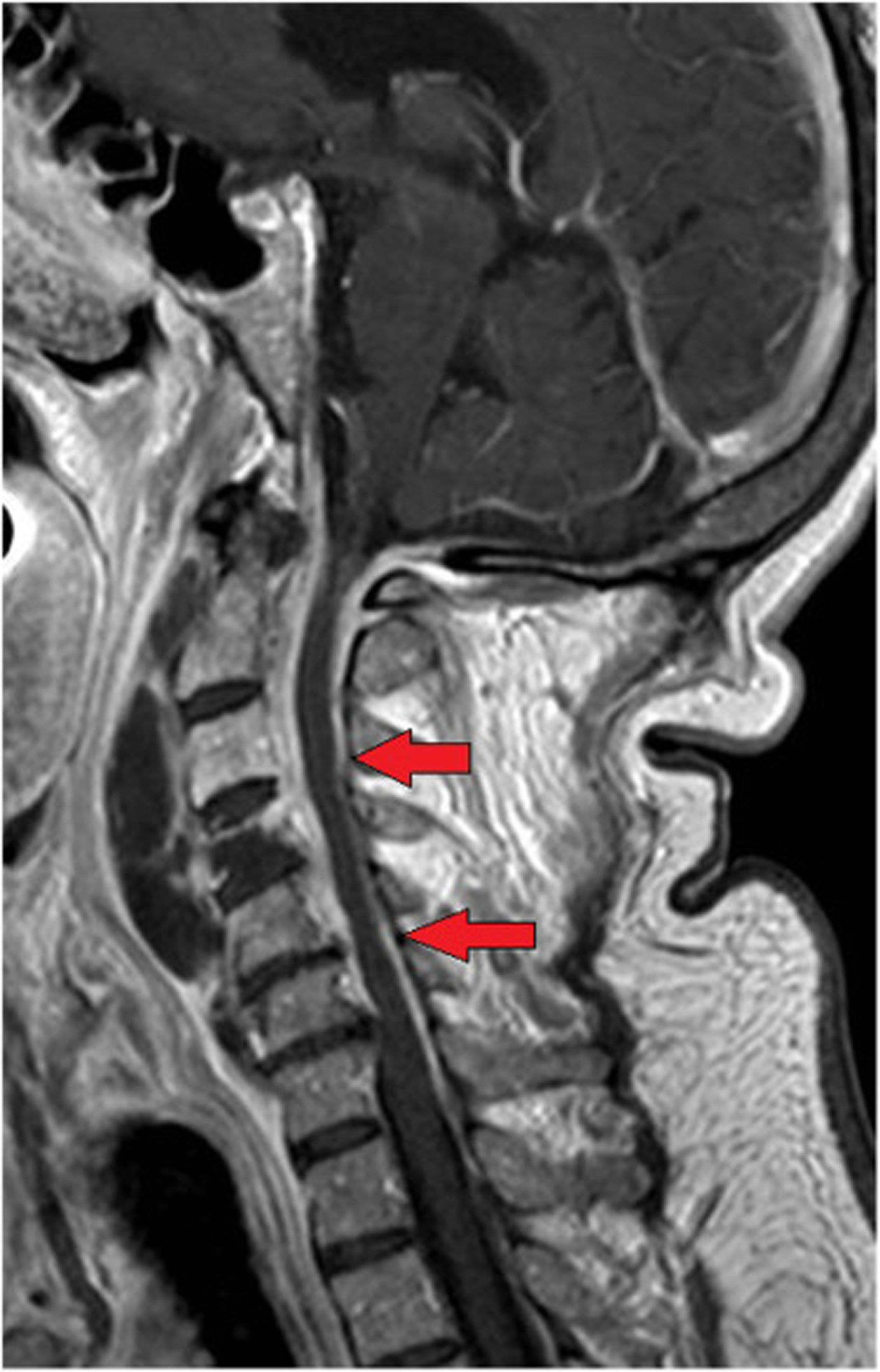 Absceso epidural por Nocardia abscessus | Medicina Intensiva