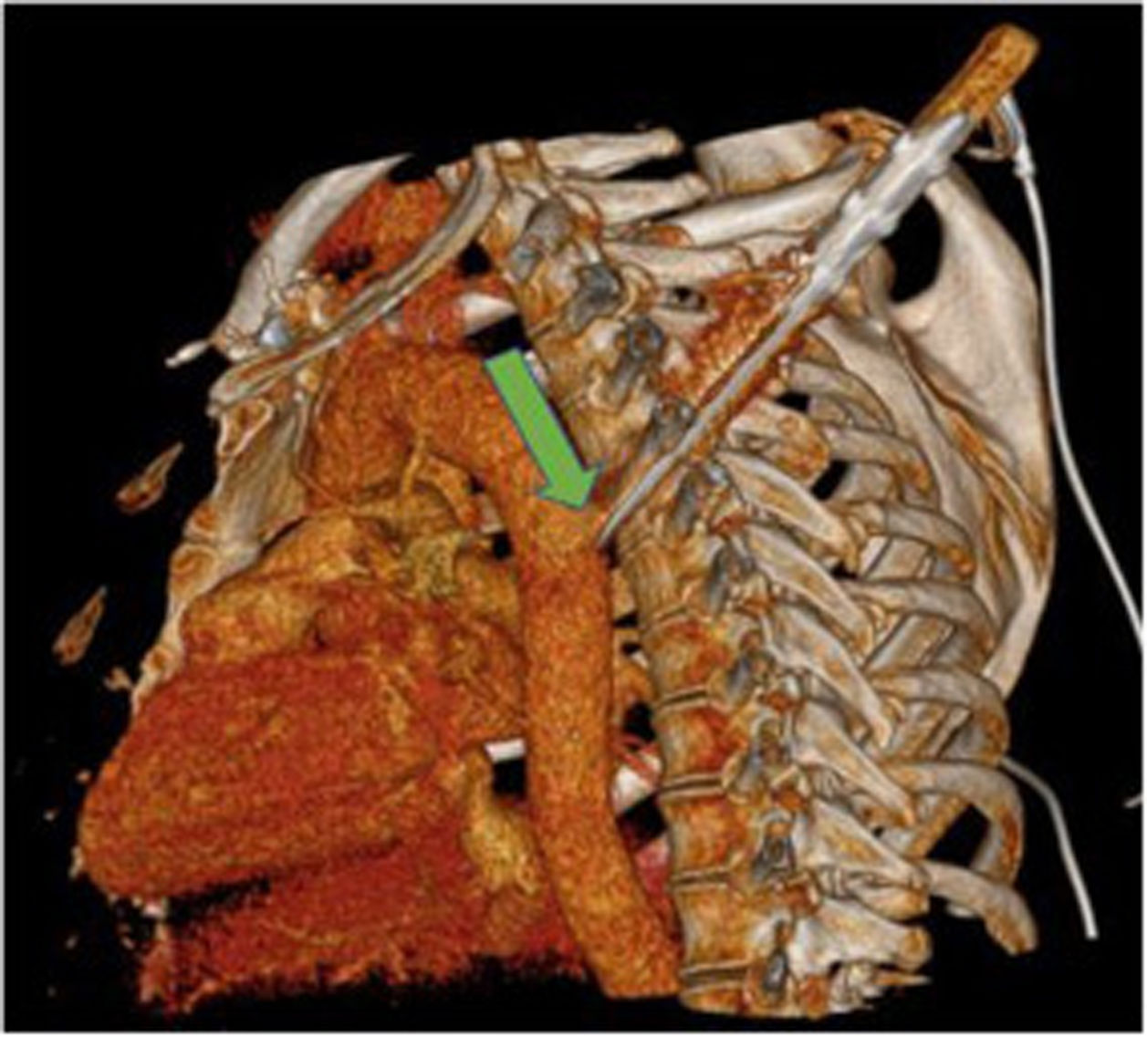 Laceración traumática de aorta torácica por herida de arma blanca ...
