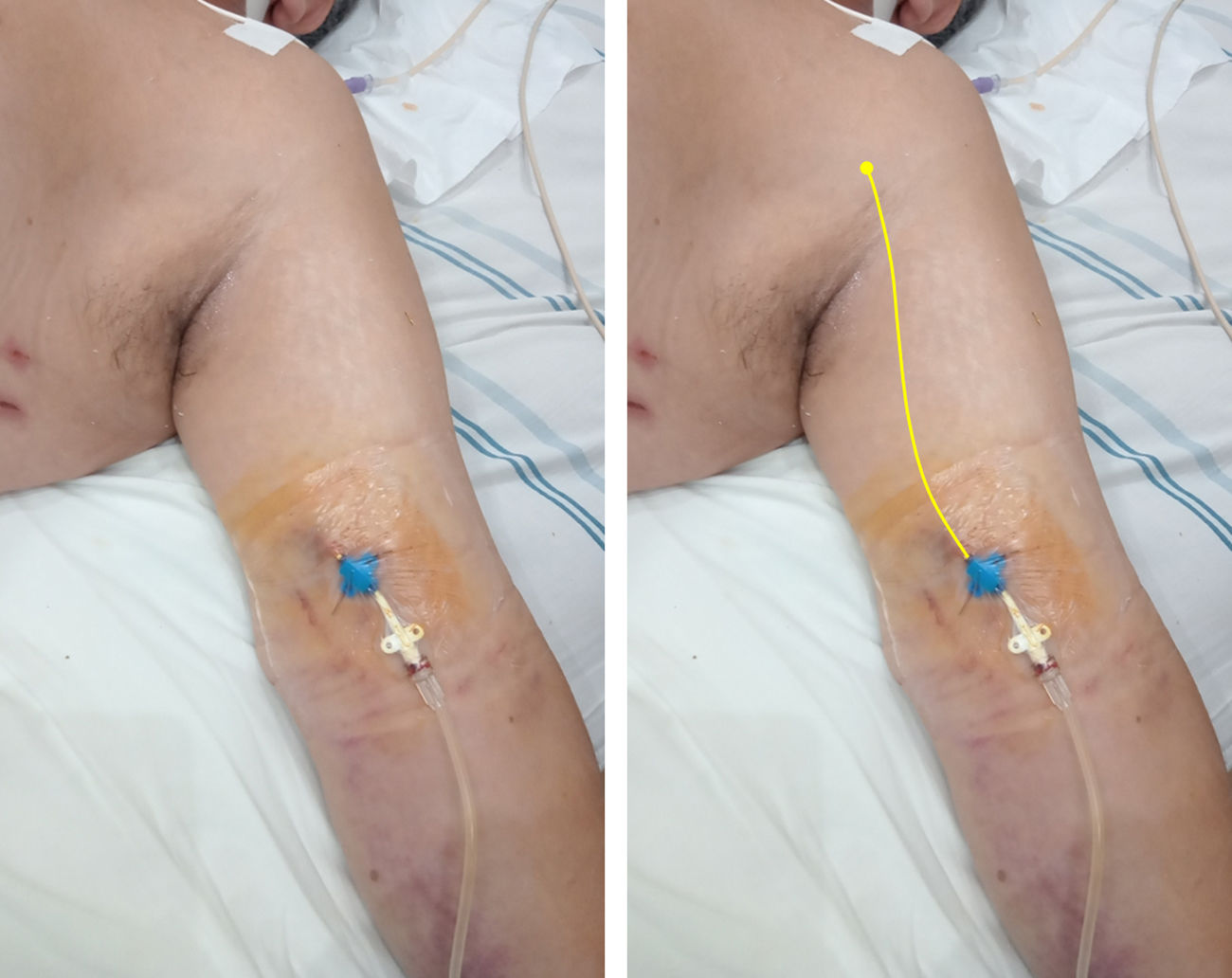 midline catheter insertion
