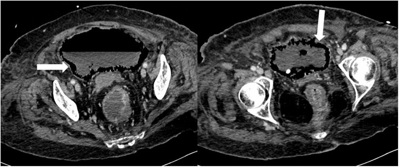 emphysematous cystitis