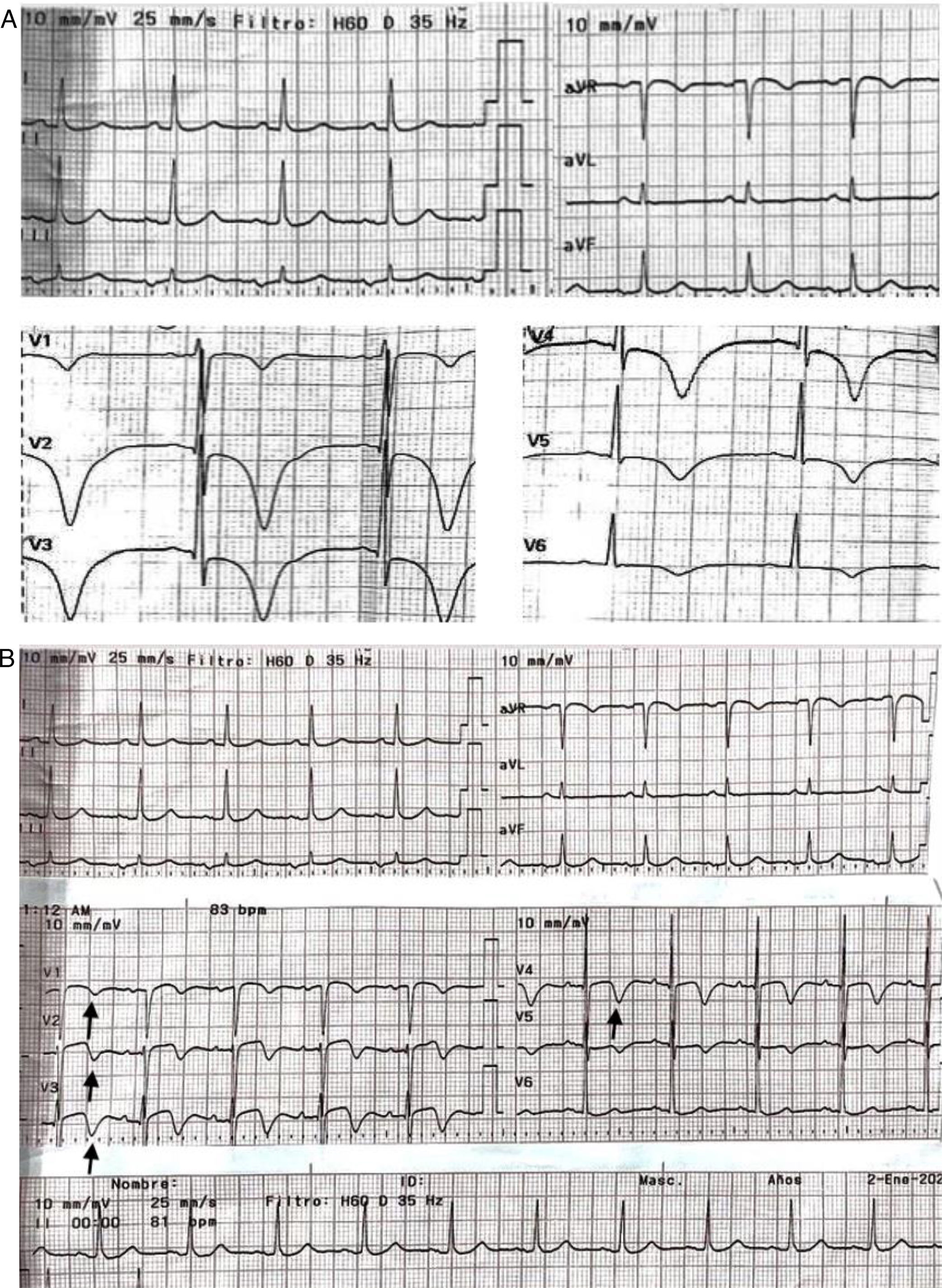 Wellens Syndrome: Be aware of T wave inversion | Medicina Intensiva
