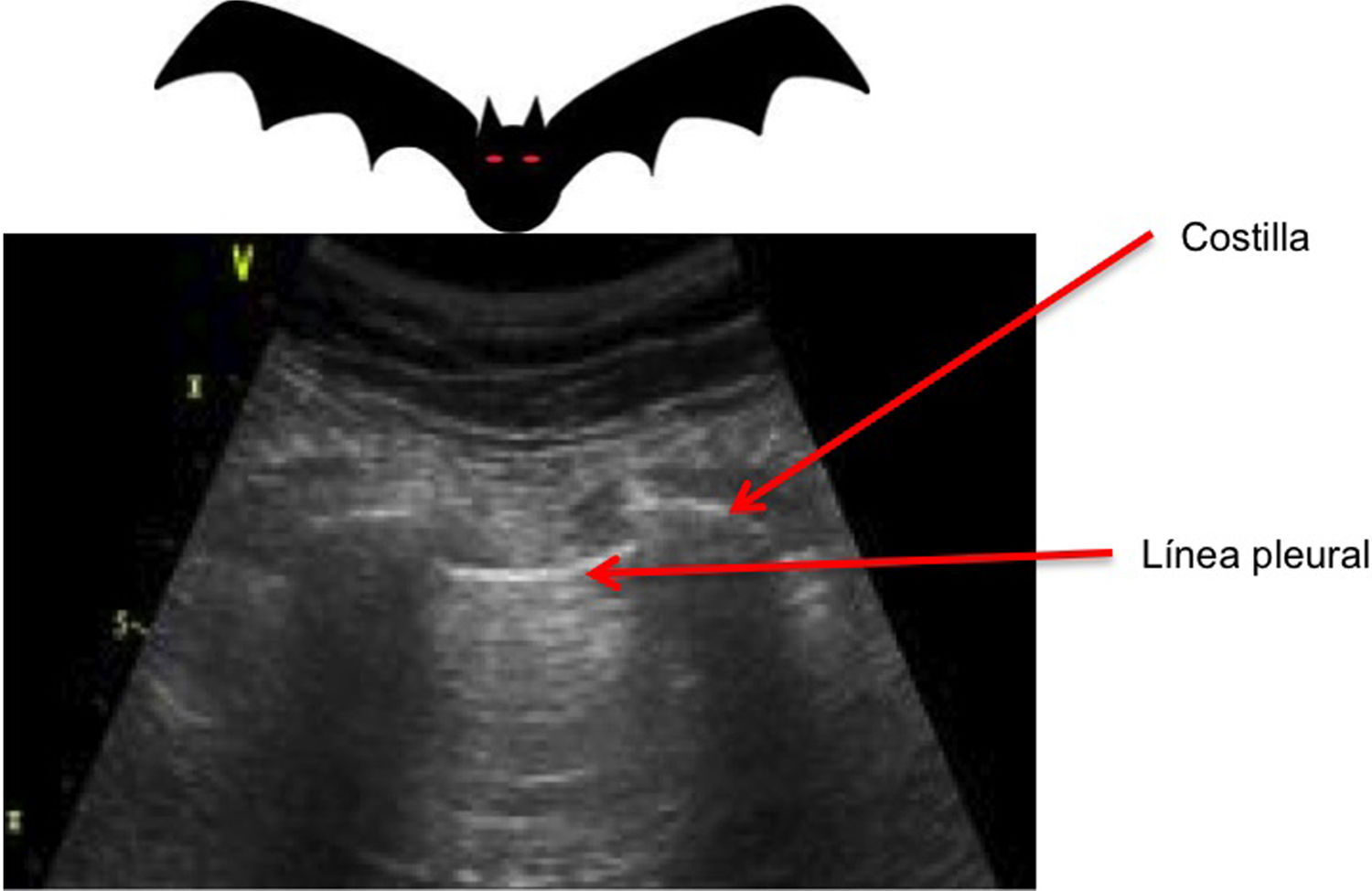 Ecografía pleuropulmonar y diafragmática en medicina intensiva ...