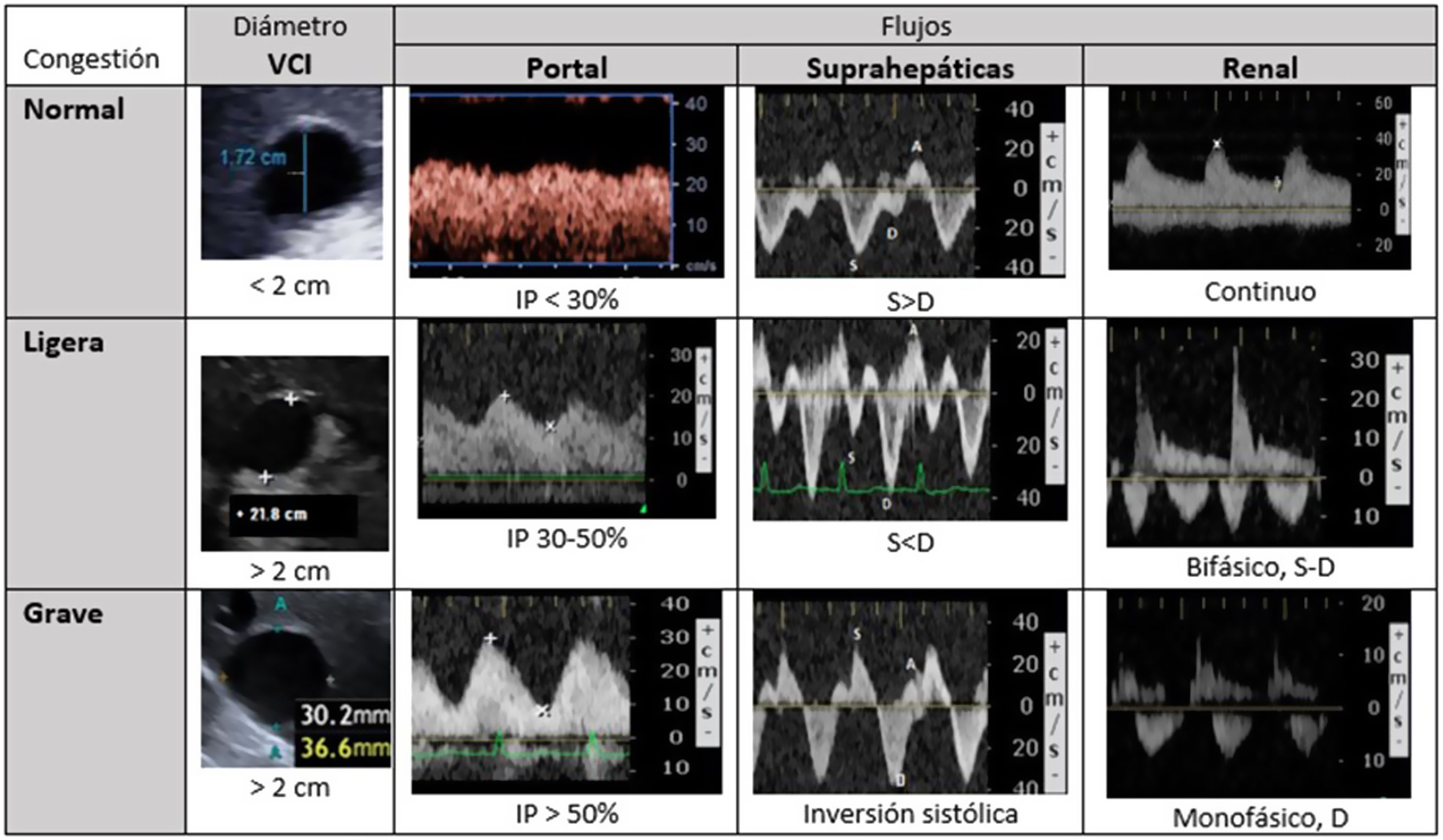 Ecografía abdominal básica en medicina intensiva y VExUS Score | Medicina Intensiva