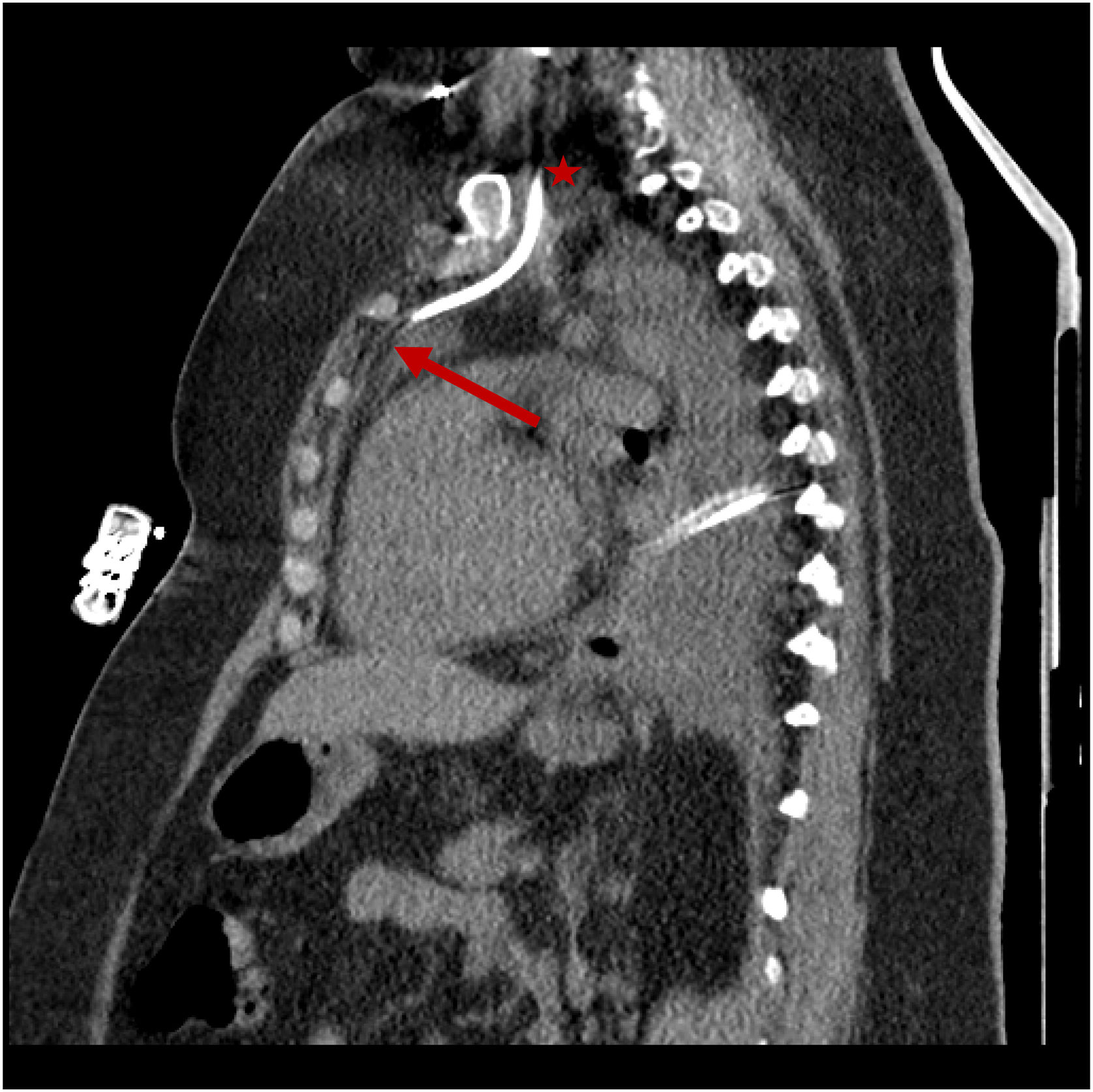 Echo-guided left internal jugular vein central venous catheter ...