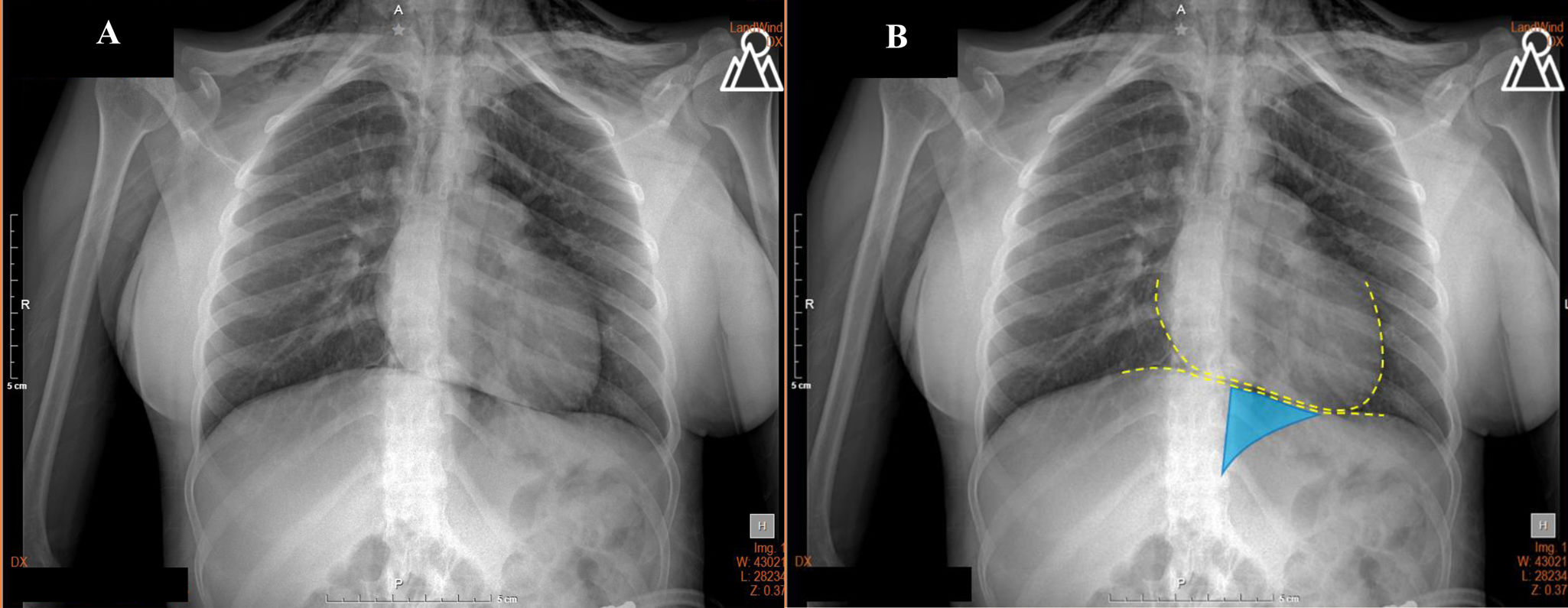 continuous diaphragm sign