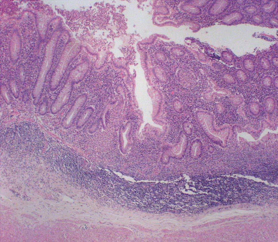 Infección cecal por citomegalovirus en paciente apendicectomizado con ...
