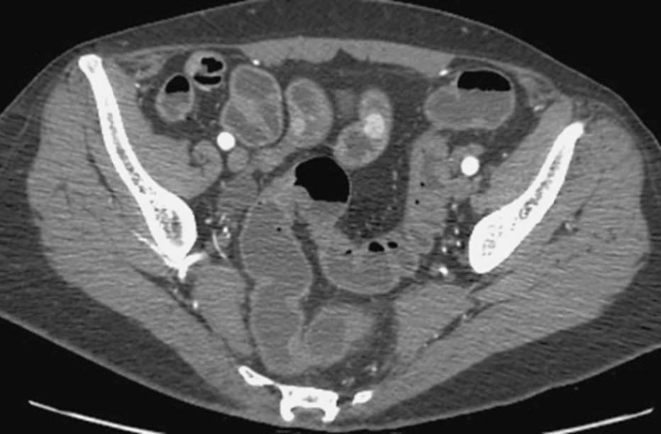 Avances en radiología del intestino delgado: enteroclisis por ...
