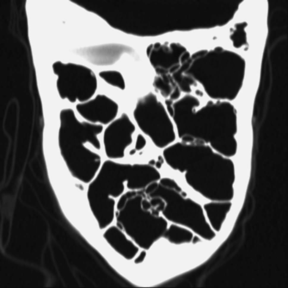 Avances en radiología del intestino delgado: enteroclisis por ...