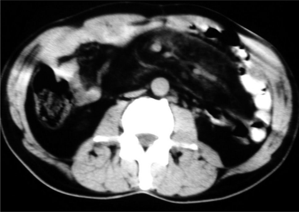 Linfoma intestinal y paniculitis mesentérica: complicaciones de una ...
