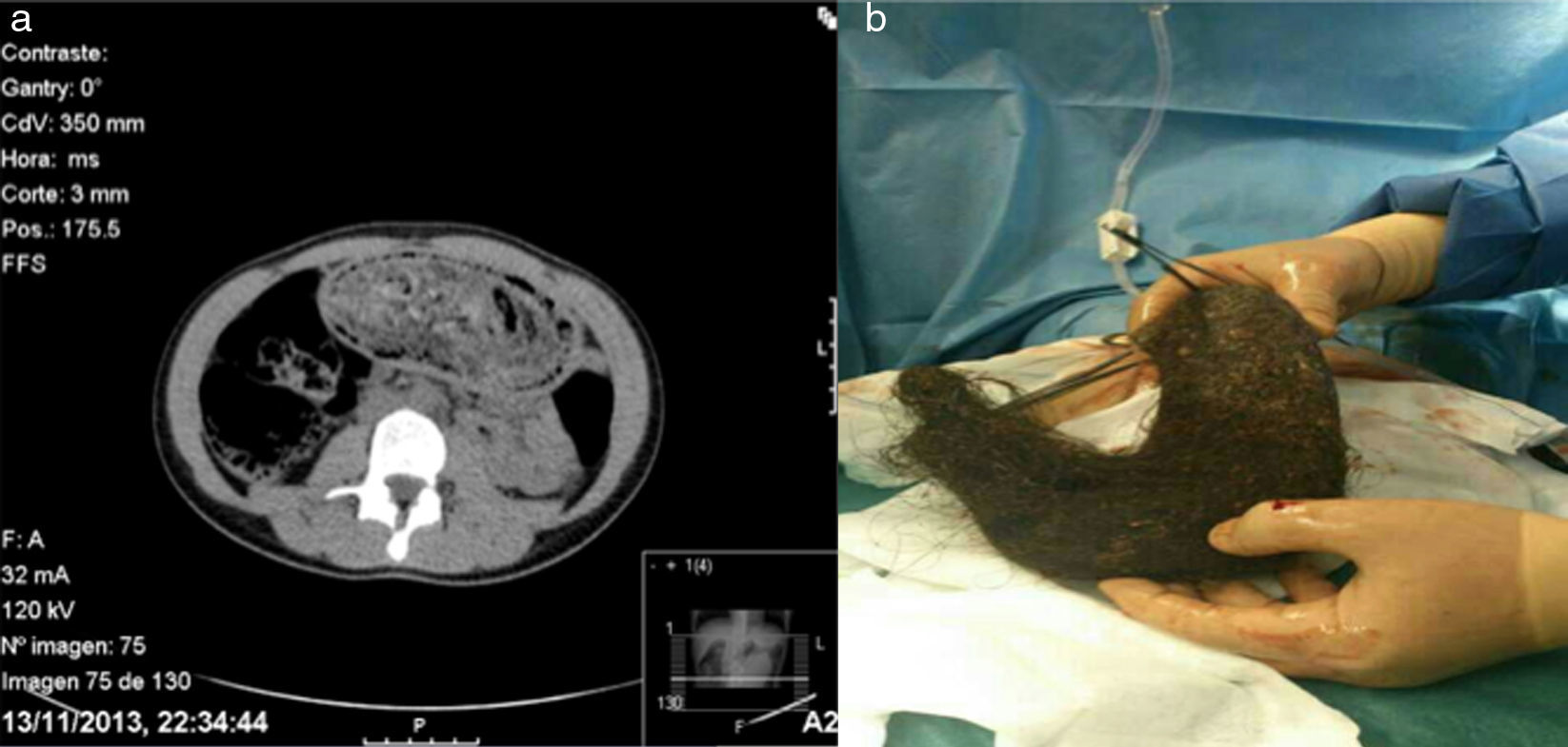 Tricobezoar como causa de obstrucción intestinal en mujer adolescente ...