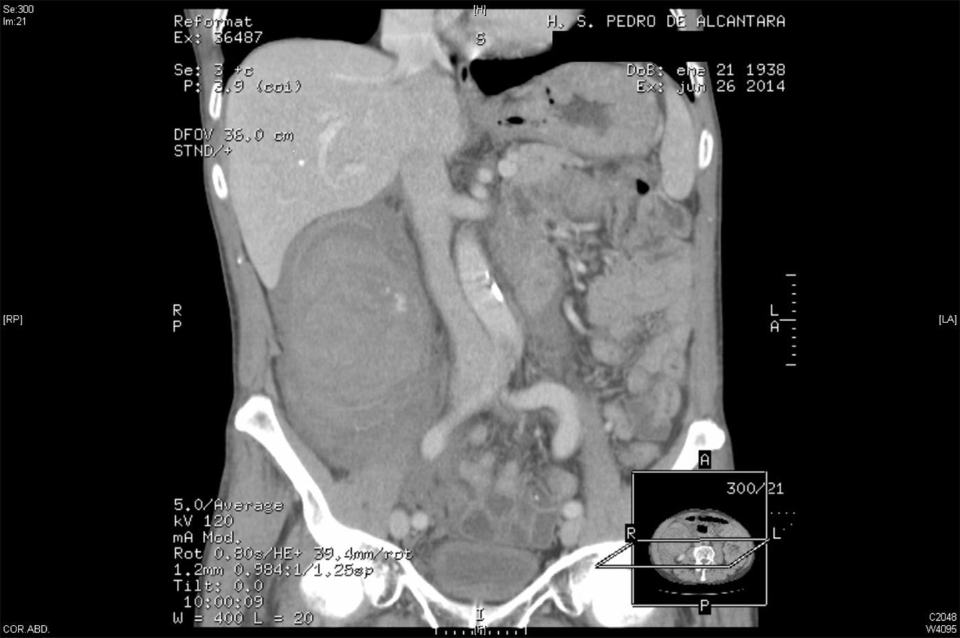 Hemoperitoneo: una complicación infrecuente de la colonoscopia ...