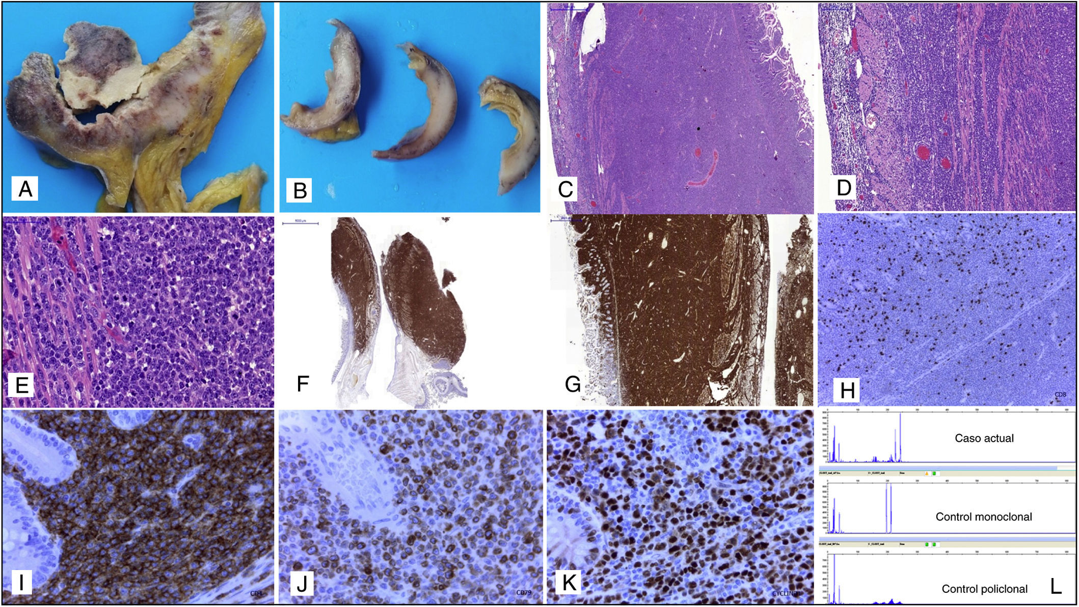 Infiltración intestinal por linfoma no Hodgkin-T de células grandes de ...