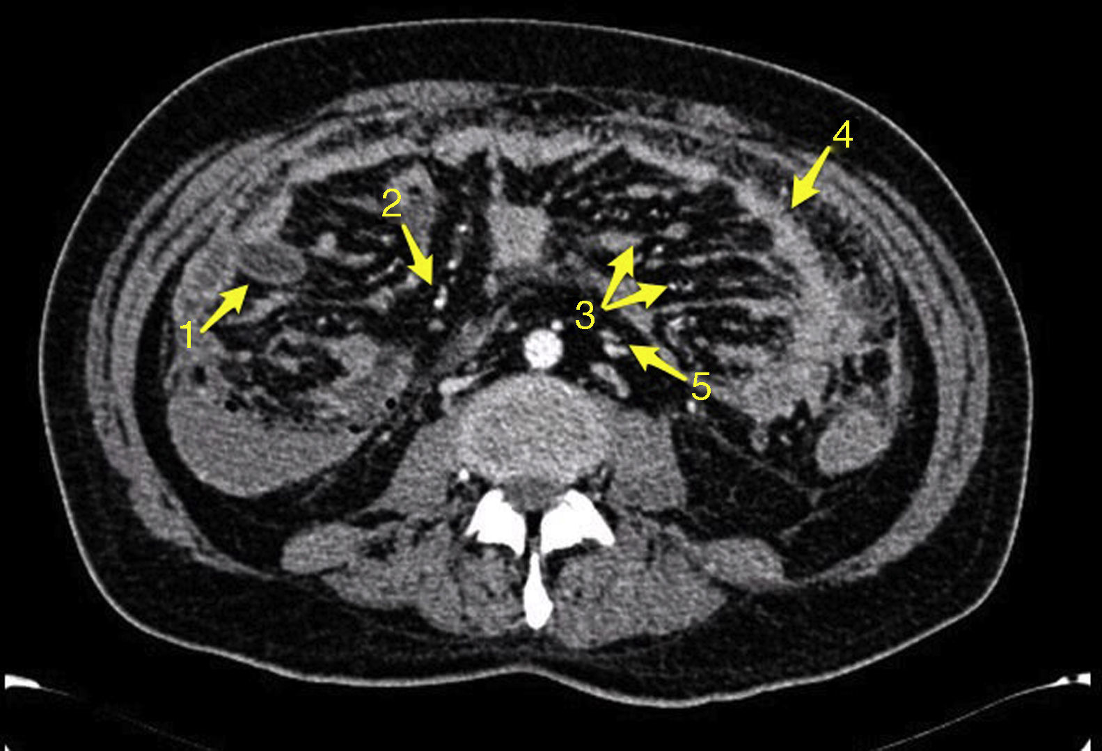 miliary tuberculosis ct