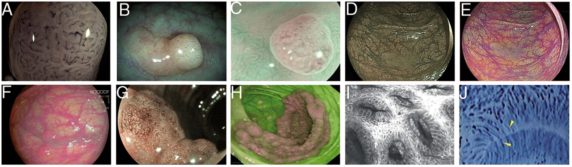 Tecnologías de endoscopia avanzada para mejorar la detección y ...