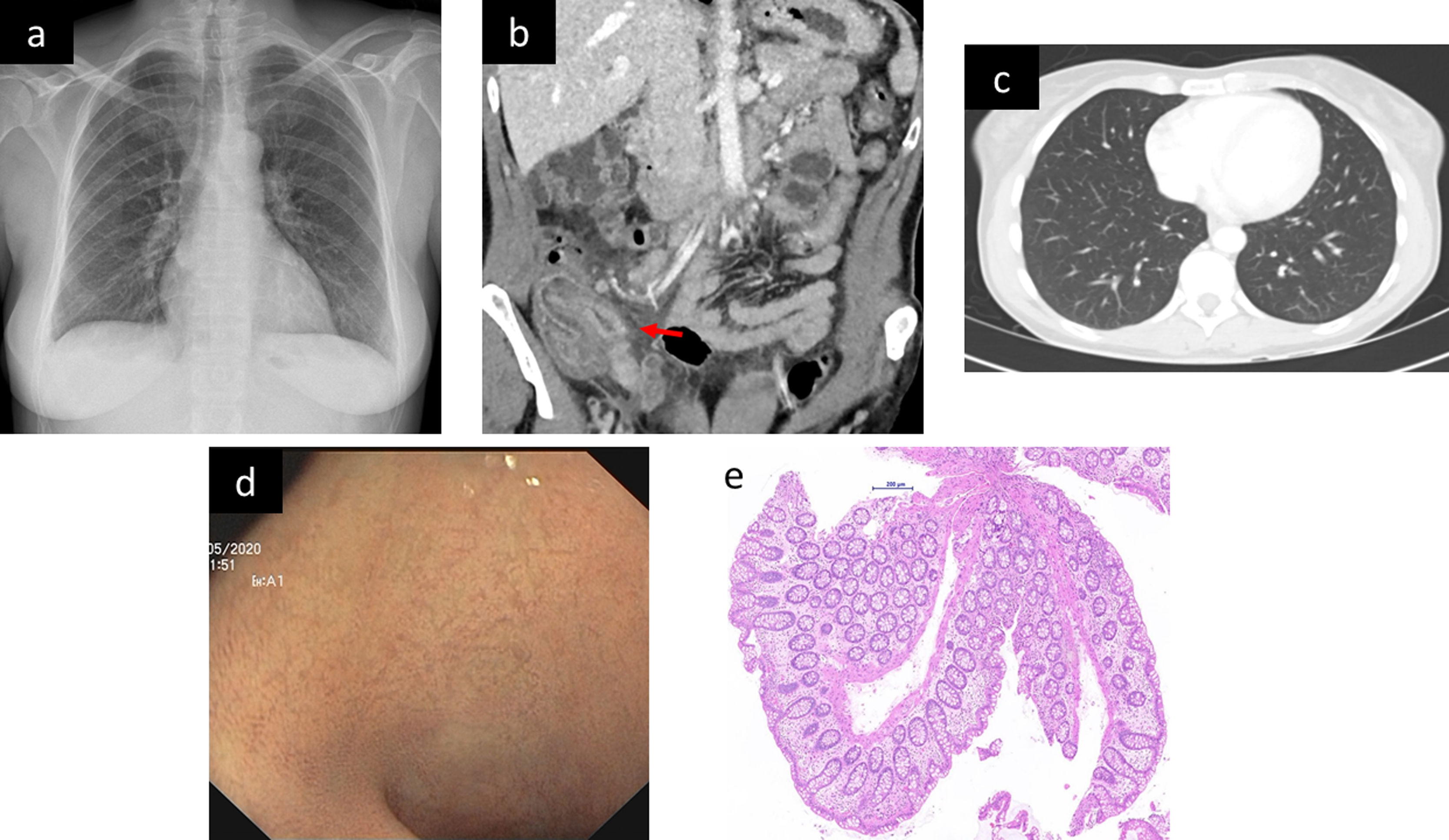 Ileitis as the exclusive manifestation of COVID-19. The first reported ...