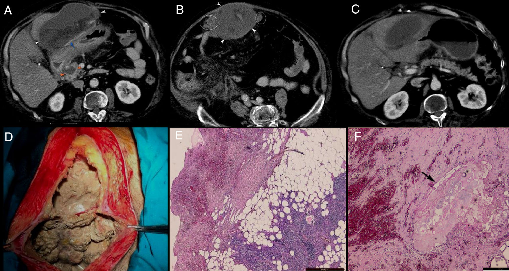 Post-pancreatitis omental fat necrosis: A diagnostic dilemma ...