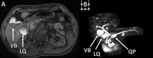 Vesícula biliar septada | Gastroenterología y Hepatología