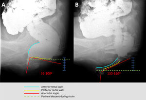 defecating proctography