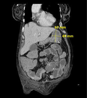 Uncommon cause of upper gastrointestinal bleeding: Spontaneous large ...