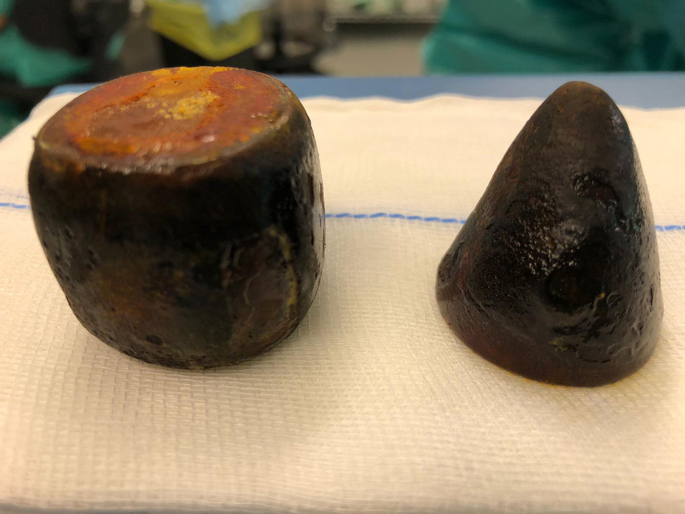 Íleo biliar por fístula colecistocólica con colon transverso ...