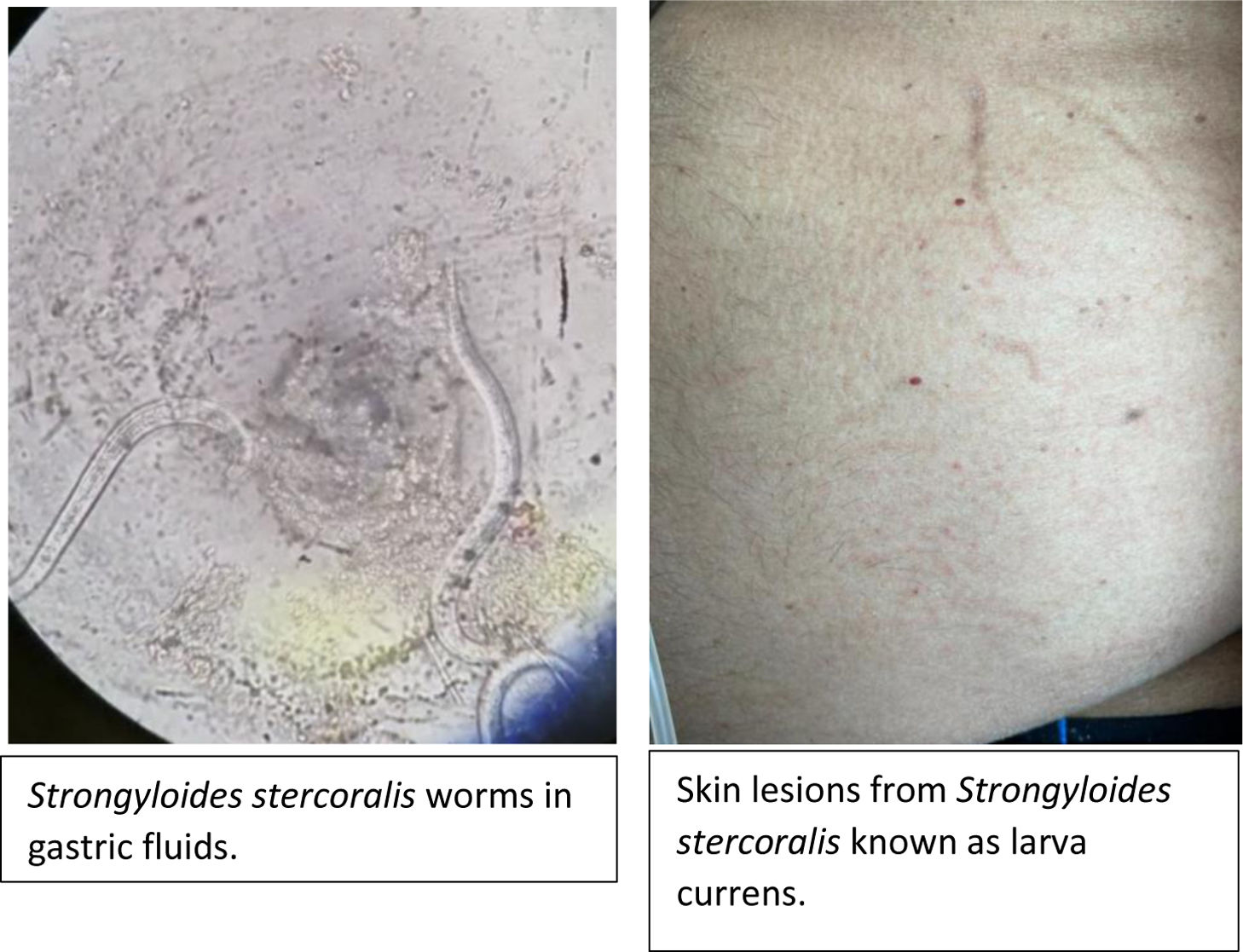 Strongyloides stercolaris hyperinfection syndrome in ulcerative colitis ...