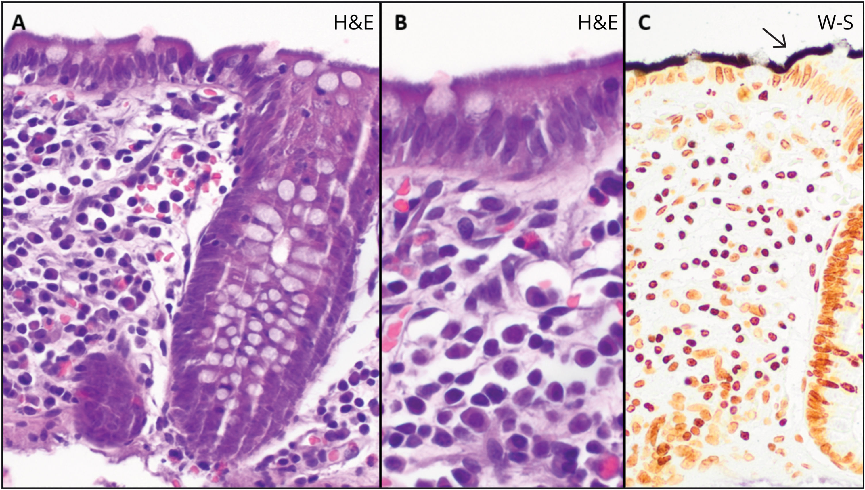 A rare case of Colonic Spirochetosis | Gastroenterología y Hepatología