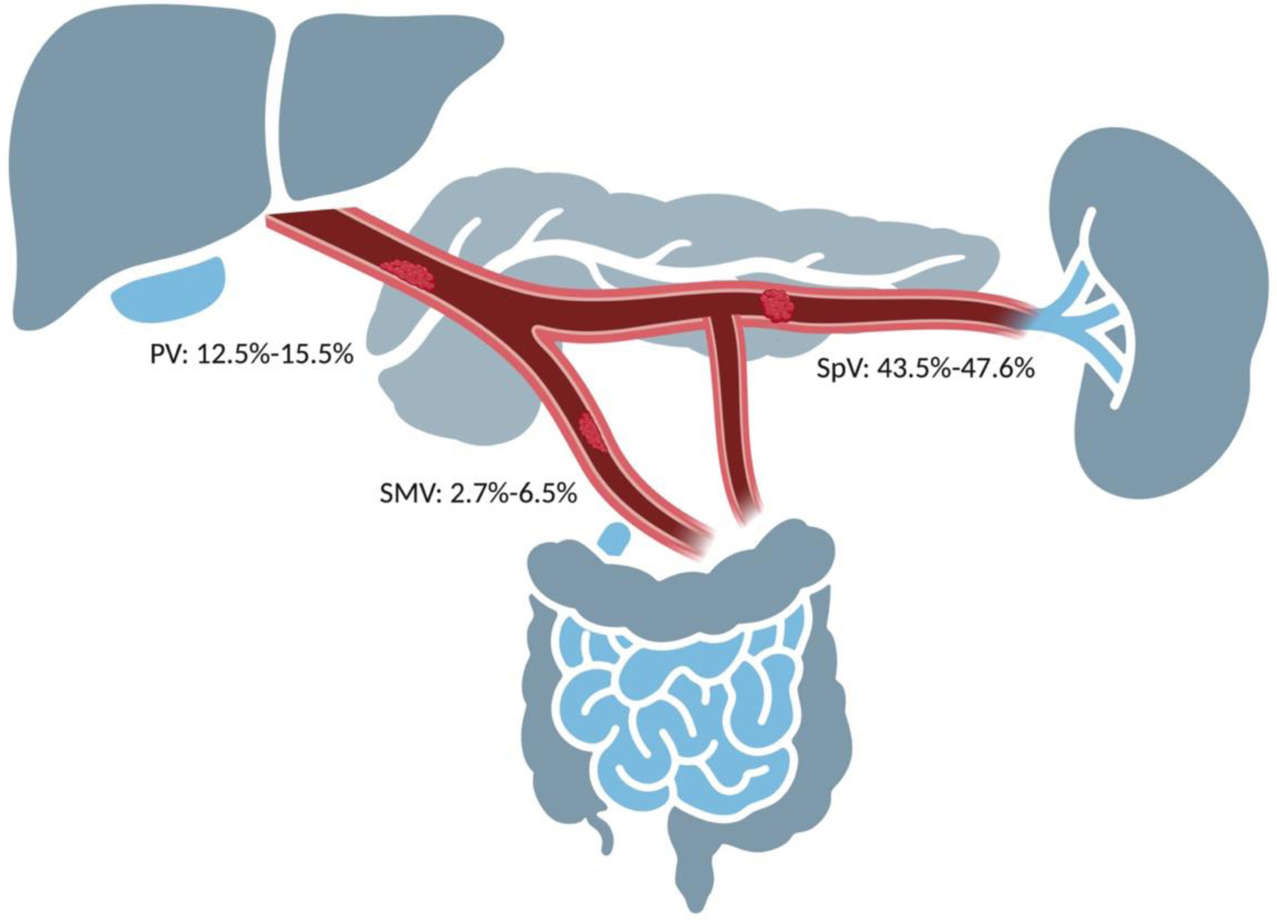 Splanchnic vein thrombosis in acute pancreatitis: Answering key ...