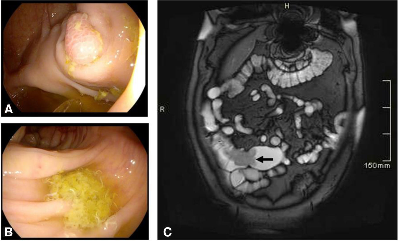Diagnóstico de pólipo fibroide inflamatorio ileal en un paciente con ...