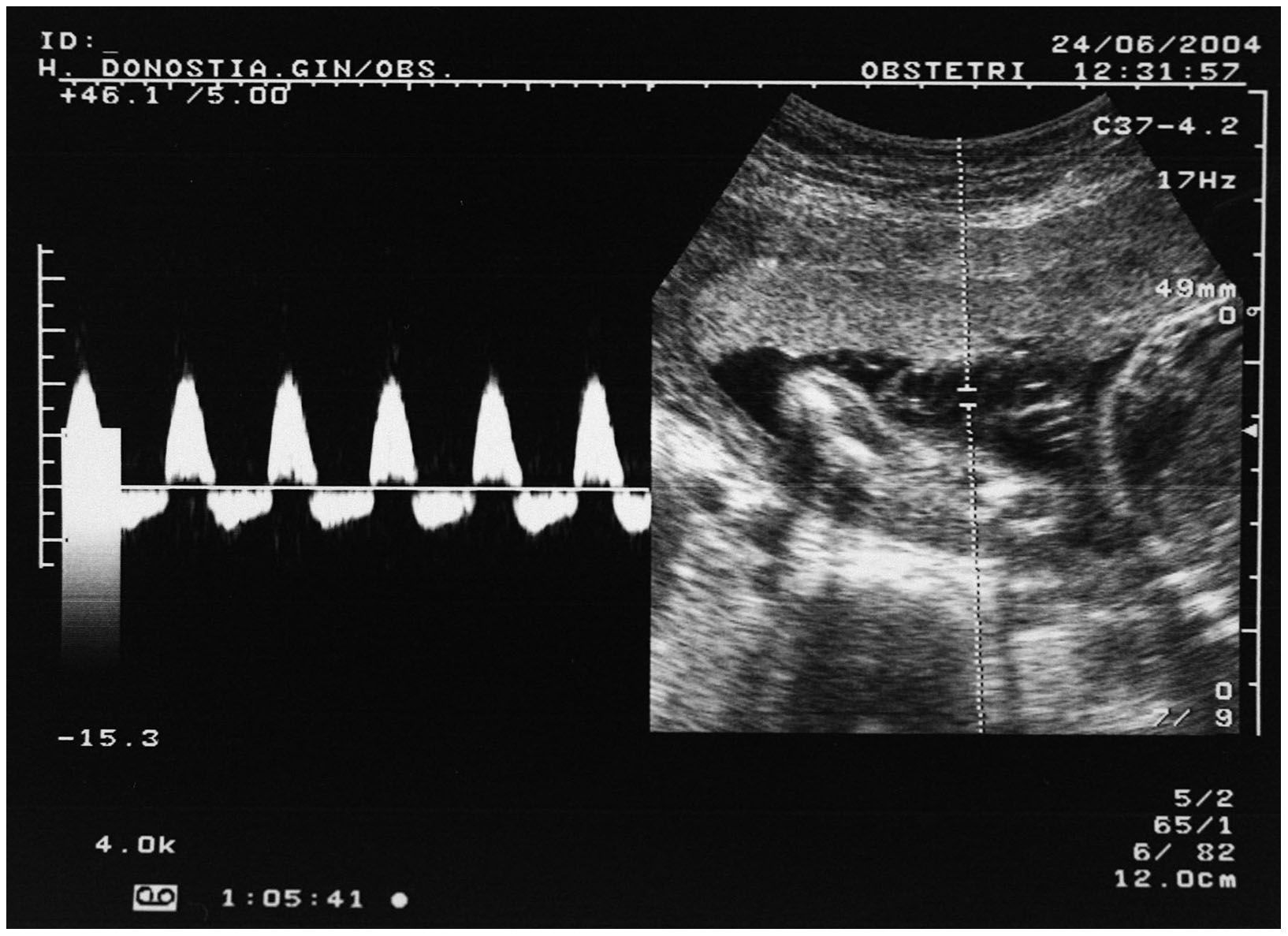 Muerte fetal anteparto y síndrome de Sjögren oculto | Clínica e ...