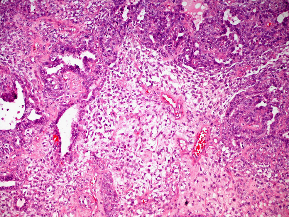 Carcinosarcoma de ovario: revisión de la literatura médica a propósito ...