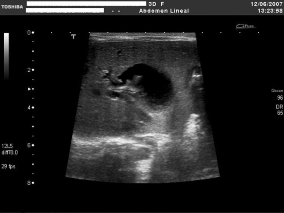 Diagnóstico prenatal de quiste de colédoco | Clínica e Investigación en ...