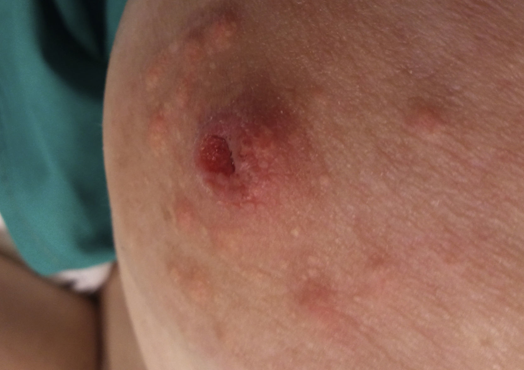 Adenoma de pezón: a propósito de un caso | Clínica e Investigación en ...