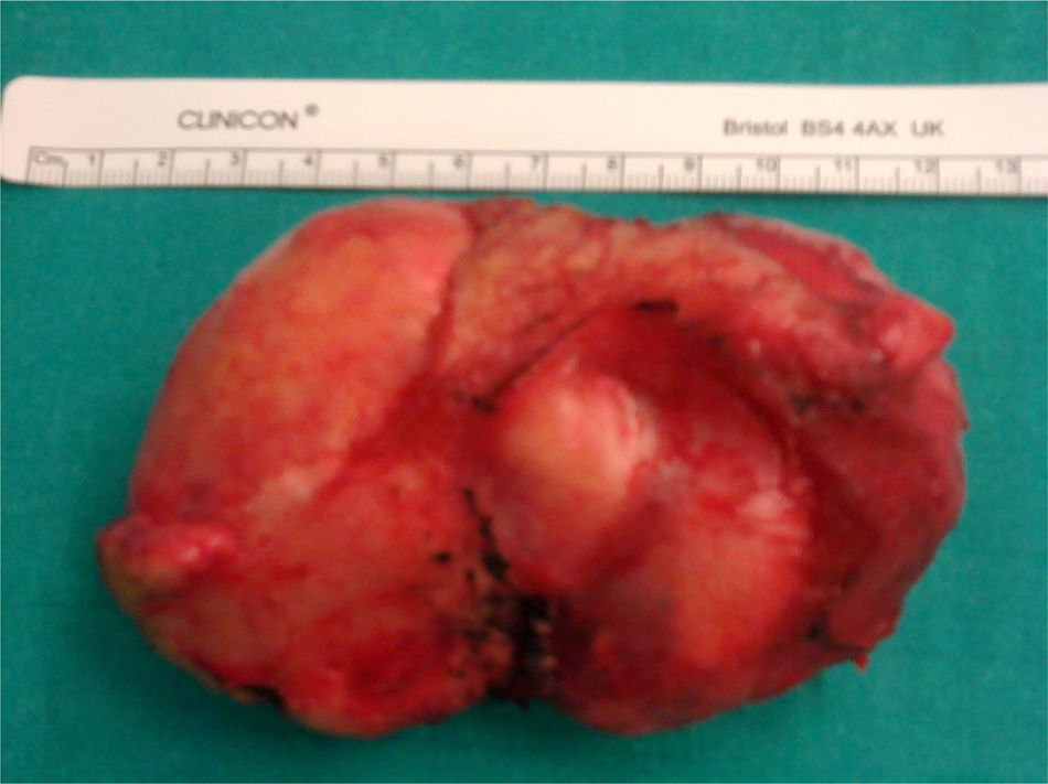 Quiste de inclusión epidérmica gigante de localización mamaria ...