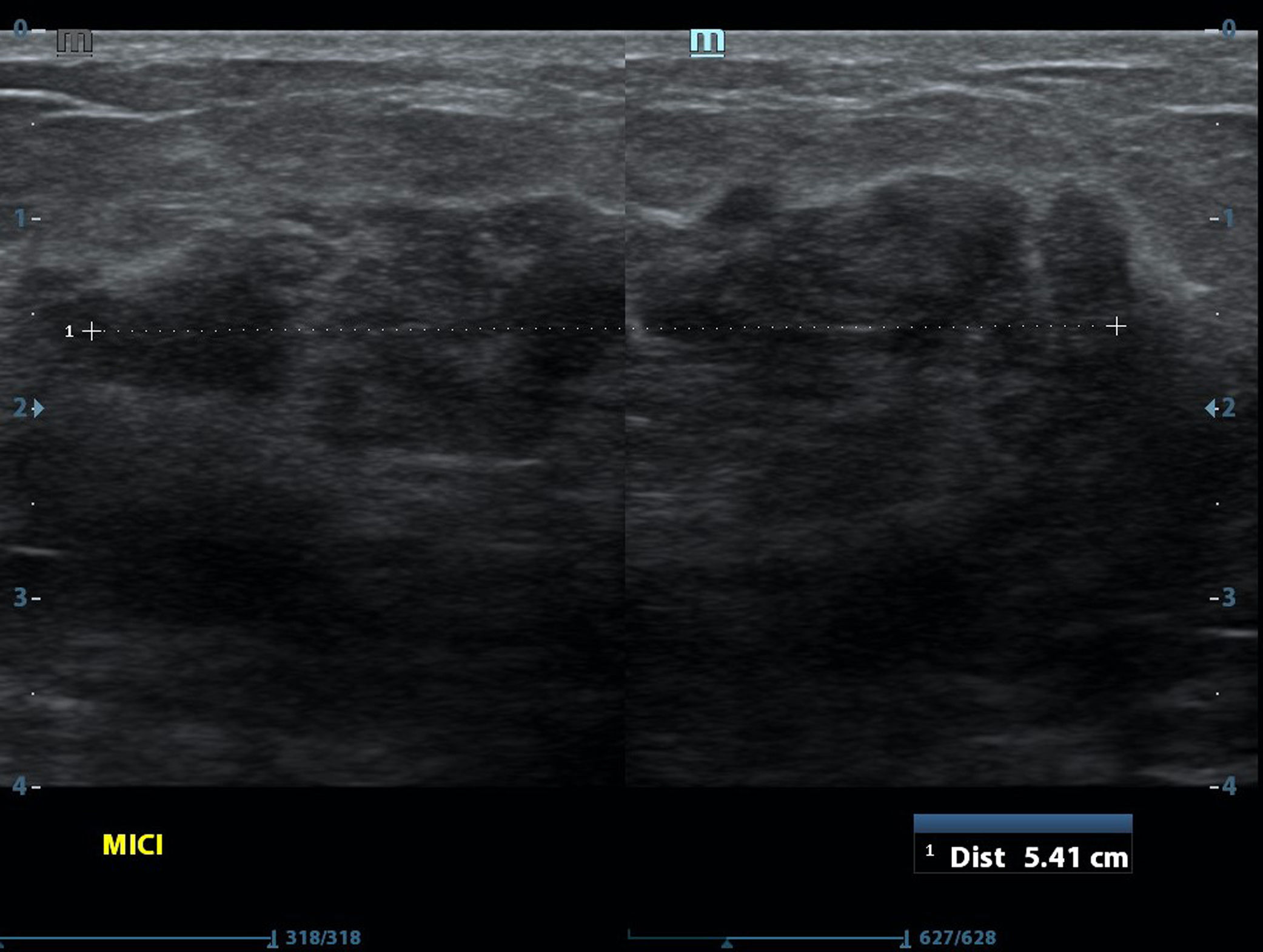 Mastitis granulomatosa idiopática complicada con absceso de mama ...