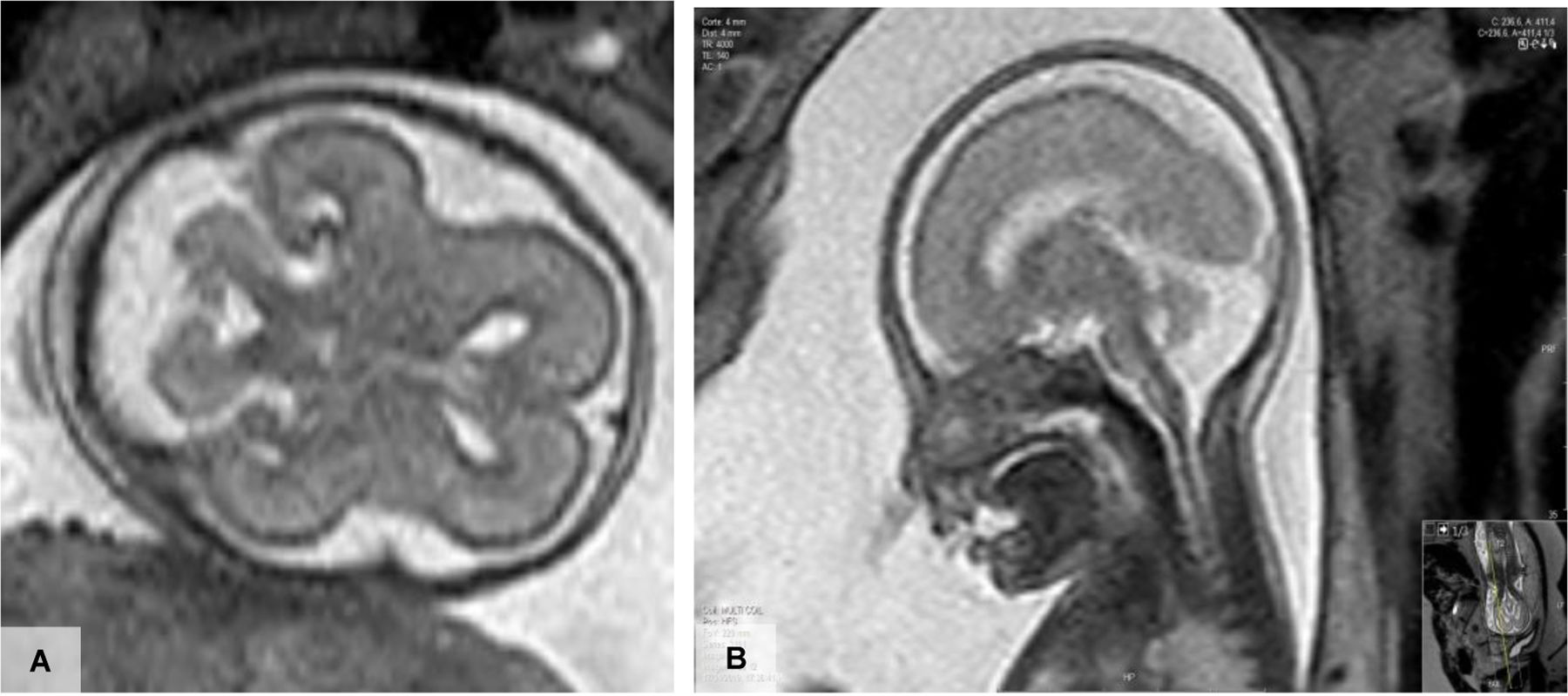 Síndrome de Joubert: un reto para el diagnóstico prenatal | Clínica e ...