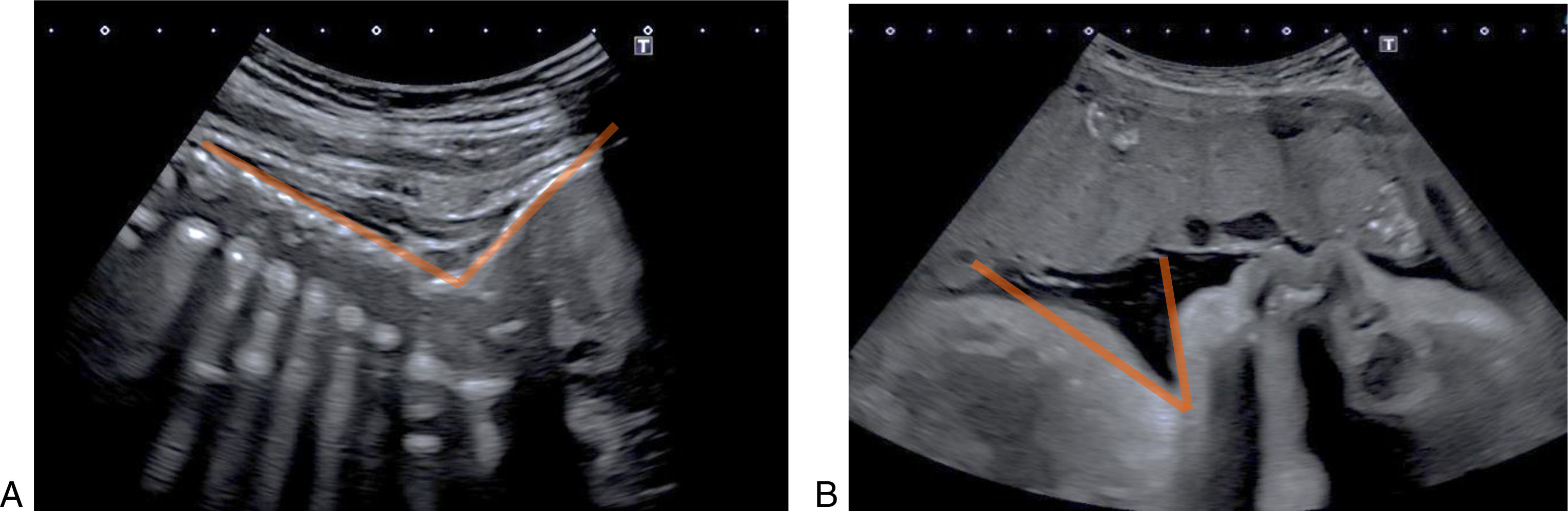Methodology and utility of intrapartum ultrasound | Clínica e ...