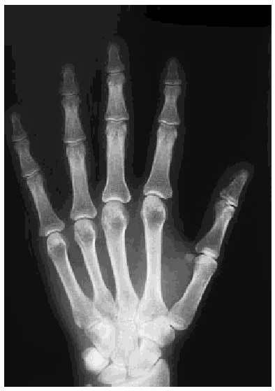 Las Lesiones De La Mano En Urgencias Medicina Integral Las Lesiones De La Mano En Urgencias Medicina Integral