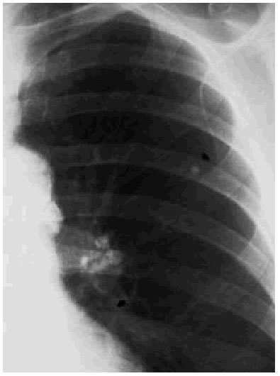 Manifestaciones radiológicas de la tuberculosis pulmonar | Medicina ...