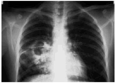 Manifestaciones radiológicas de la tuberculosis pulmonar | Medicina ...