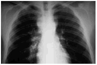 Manifestaciones radiológicas de la tuberculosis pulmonar | Medicina ...
