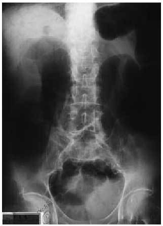Radiografía simple de abdomen | Medicina Integral